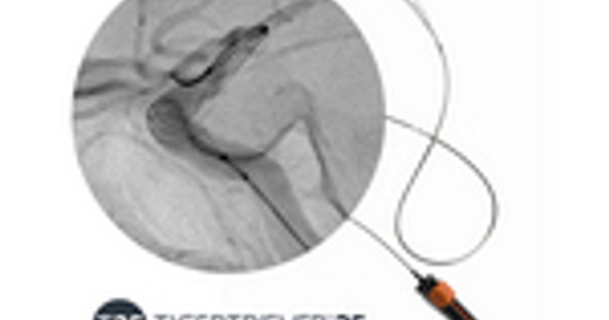 FDA Clears TIGERTRIEVER 25, A Larger, Smarter Stroke-Fighting Device ...