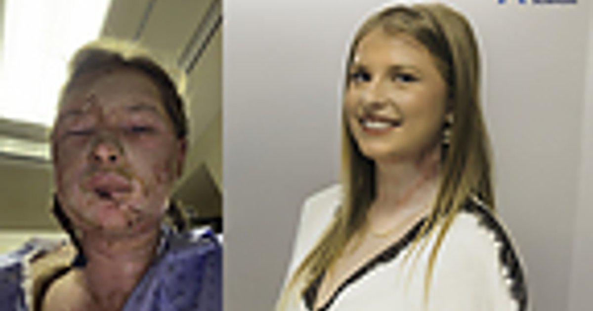 Beyond the Burn: How Cellular Messengers Are Redefining Healing ...