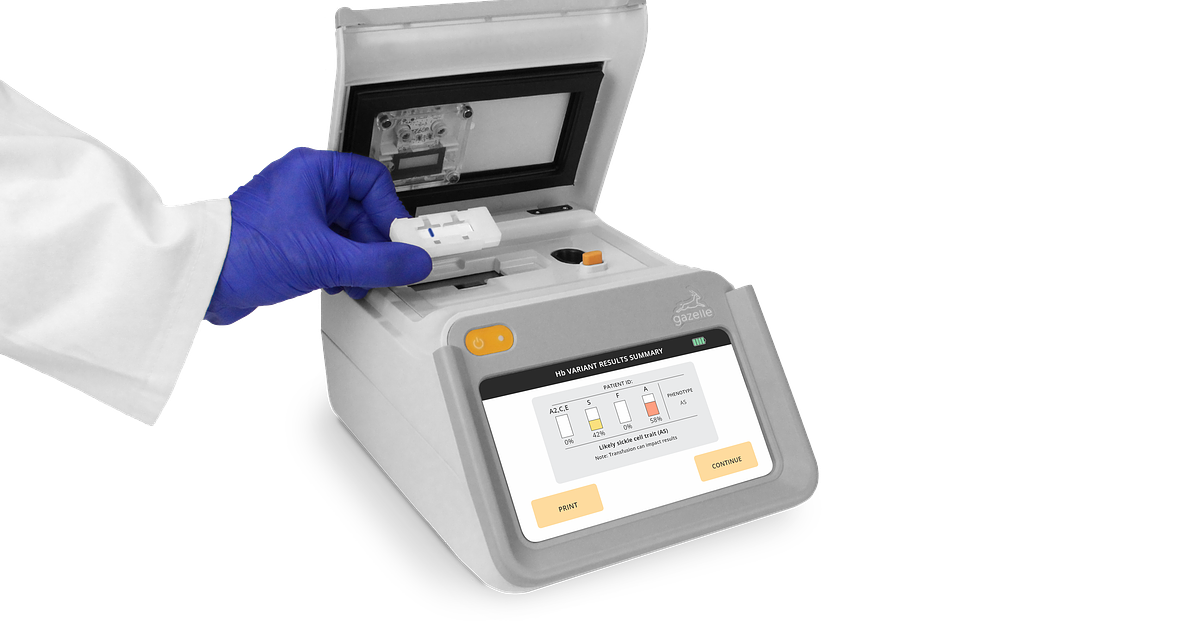 FDA Fast-Tracks Sickle Cell Test, Boosting Global Health Equity ...